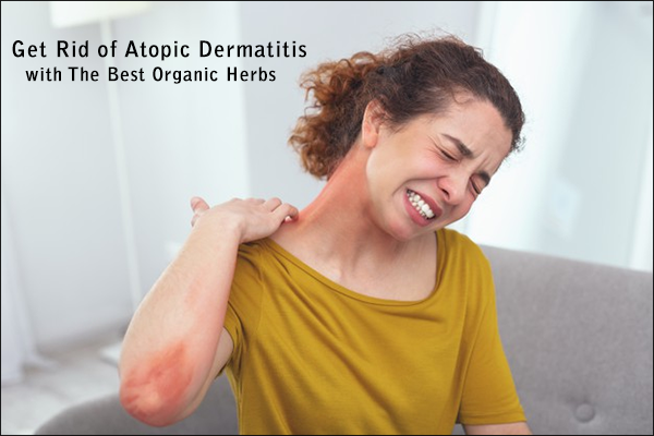 Get Rid of Atopic Dermatitis with Herbal Remedies