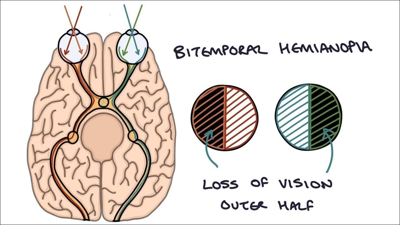 Ayurvedic Aspect And Management Of Bitemporal Hemianopia