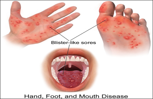 Hand Foot and Mouth Disease and Its Ayurvedic Treatment